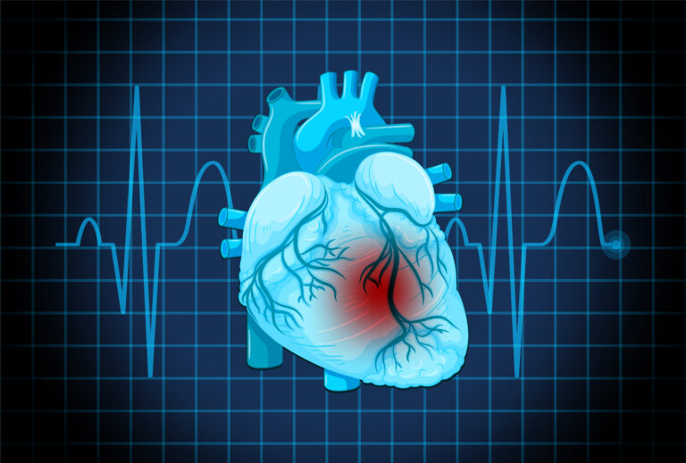 Types of Myocardial Infarction: A Guide to Heart Attack